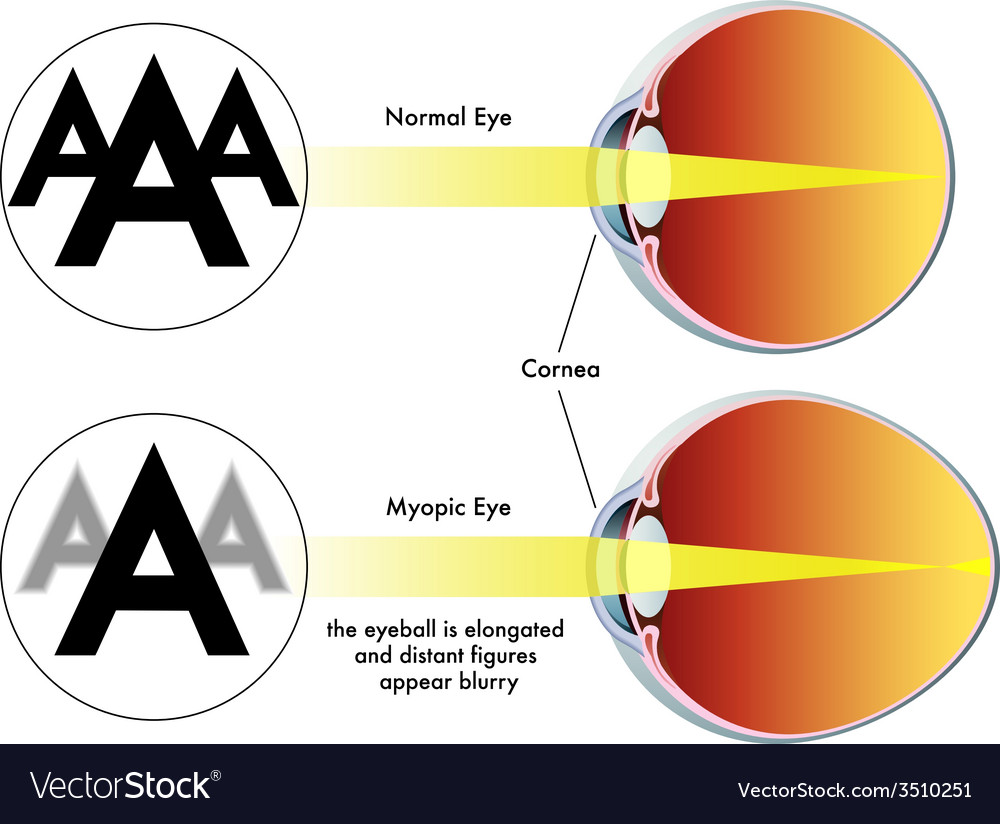 Myopia Royalty Free Vector Image - VectorStock
