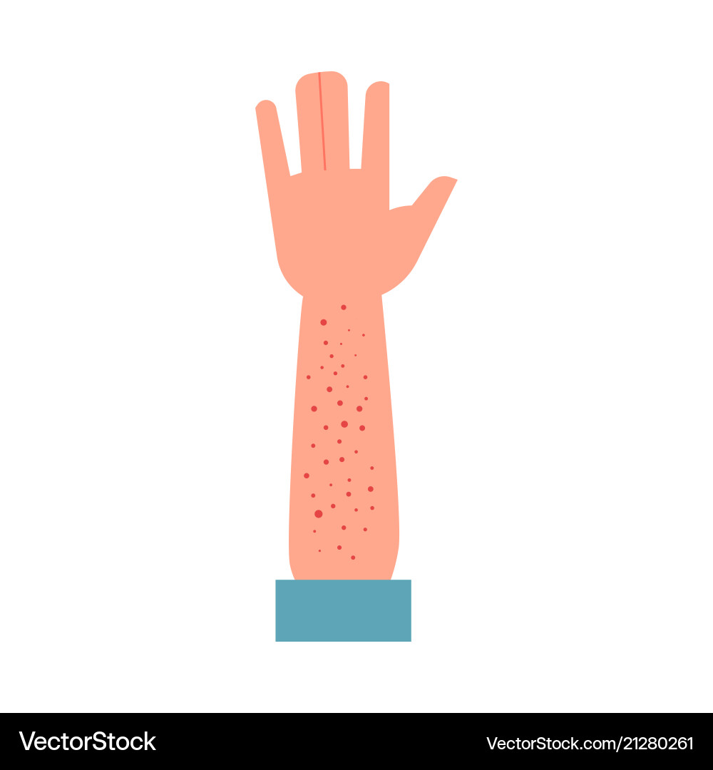 Human hand affected small red rash - symptom of Vector Image
