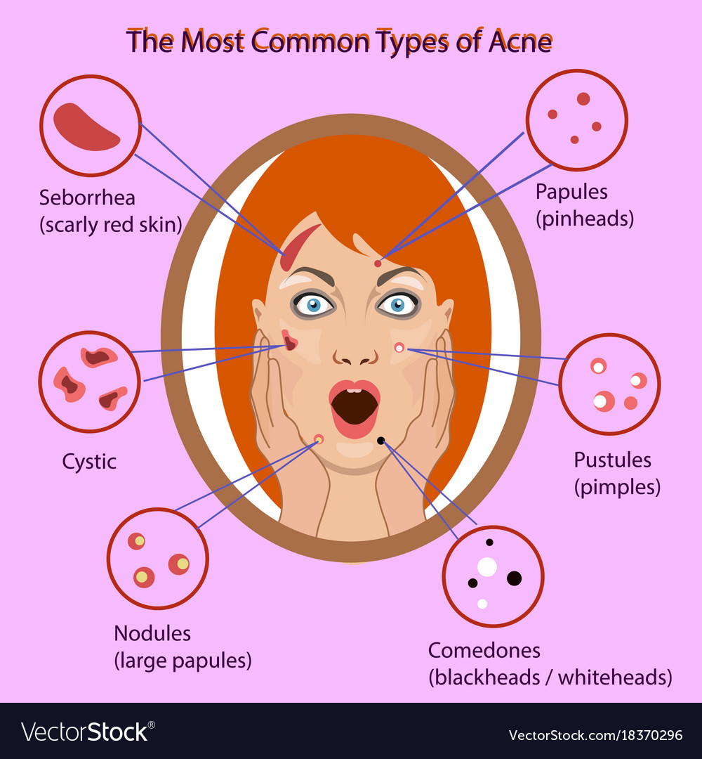 Different Type Acne Royalty Free Vector Image Vectorstock