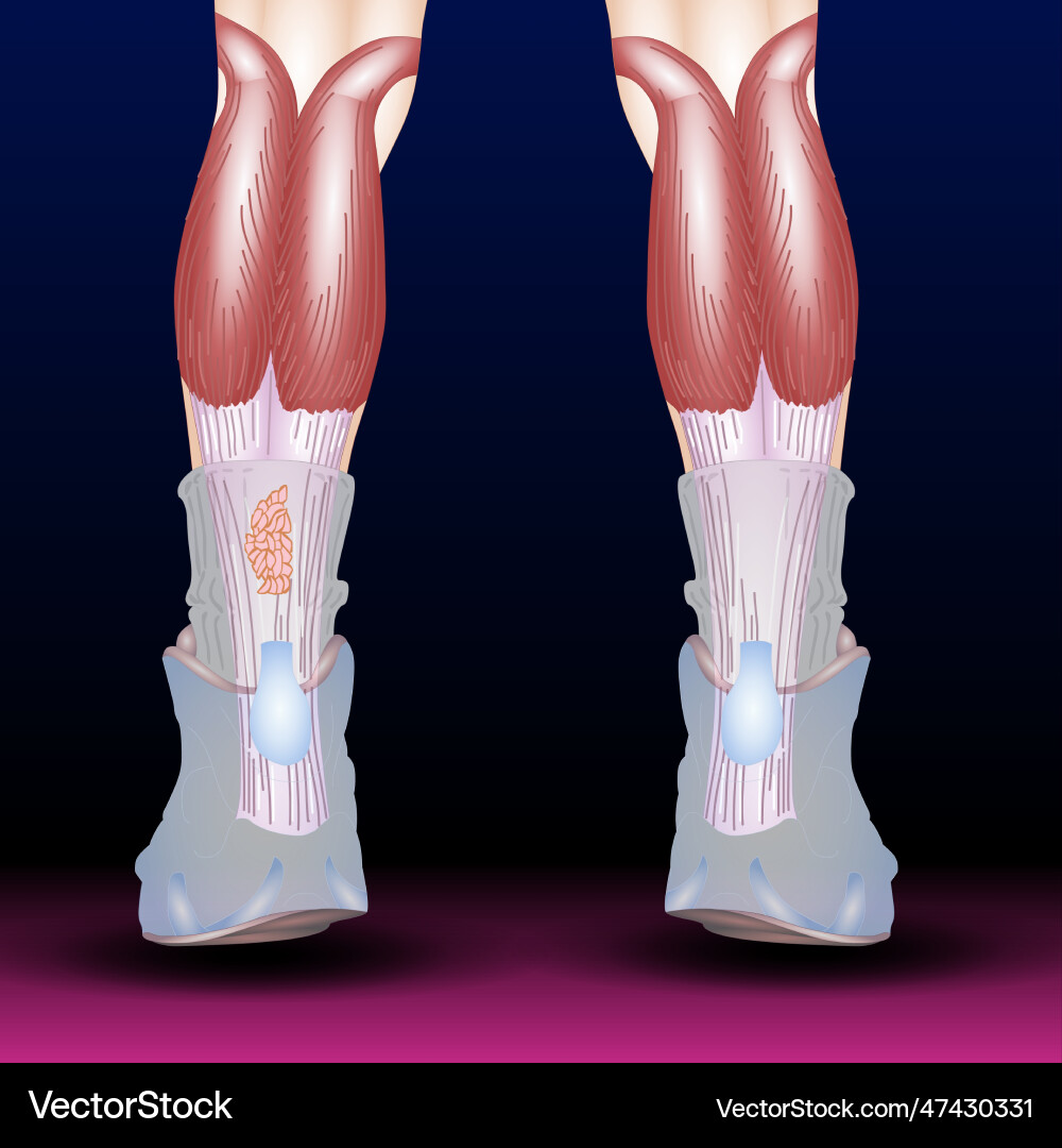 Tendinosis tennis leg Royalty Free Vector Image