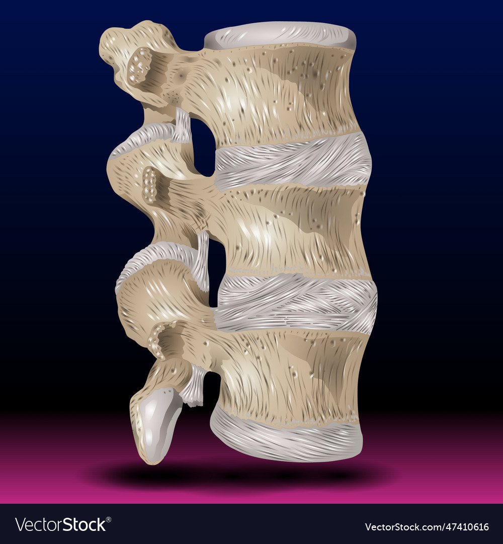 Spondylitis Royalty Free Vector Image - VectorStock