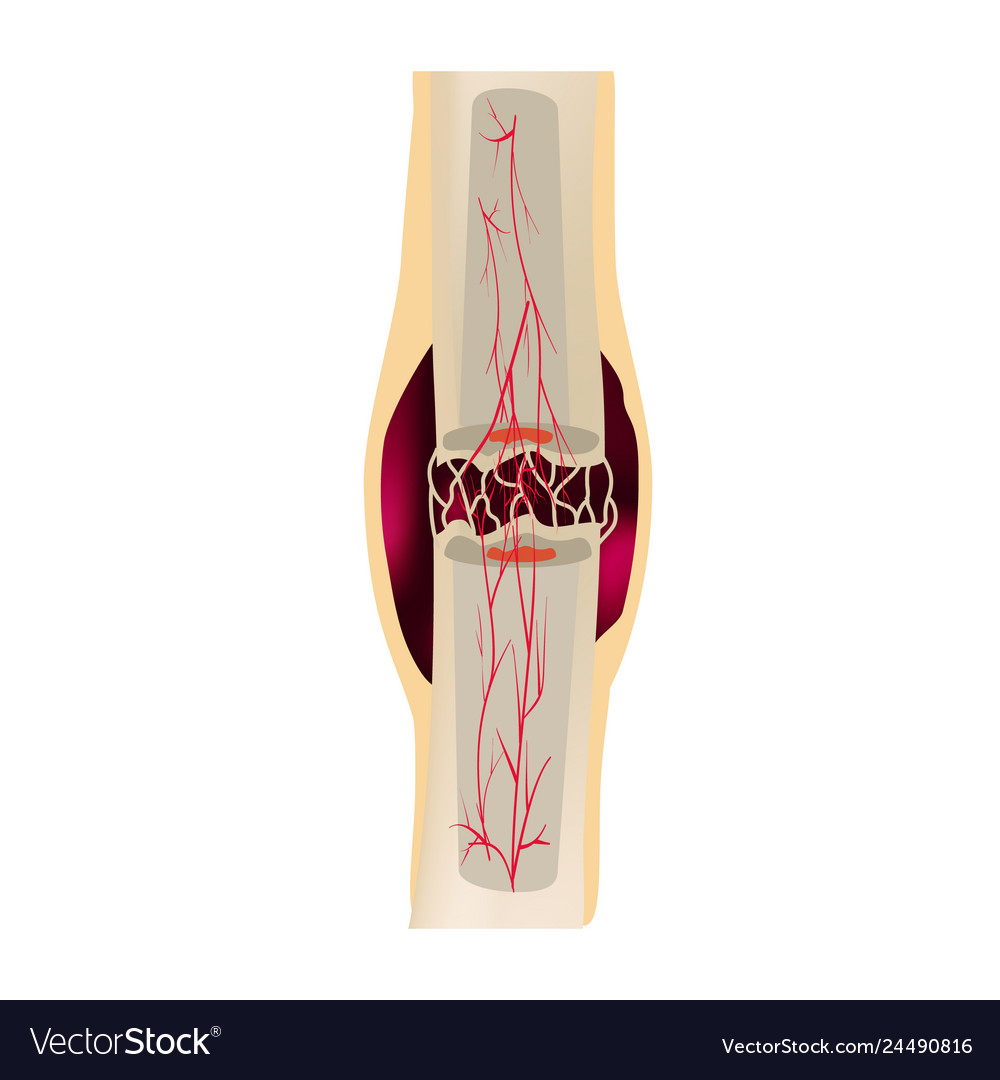 2 stage healing bone fracture formation of Vector Image