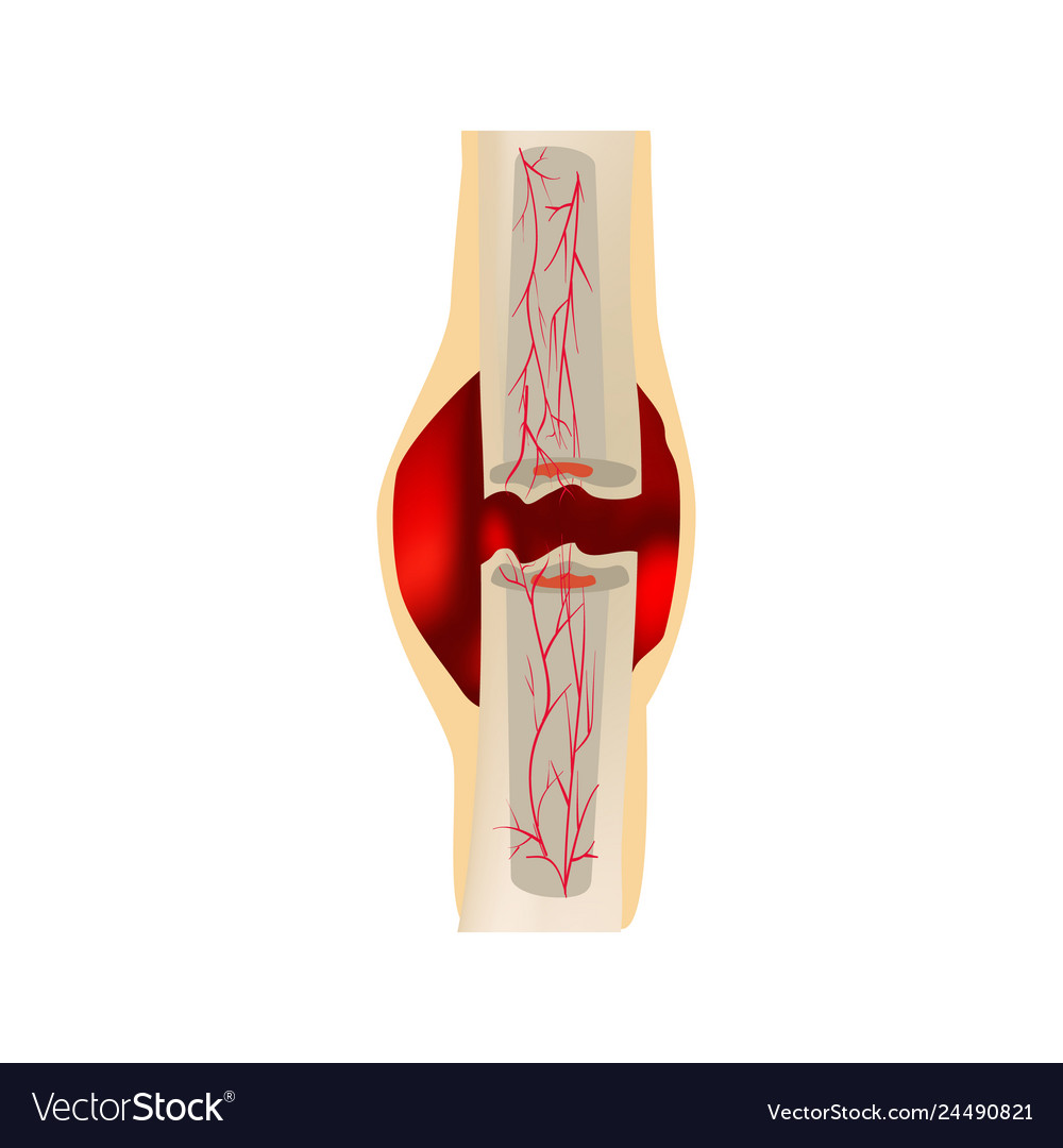 1 stage healing bone fracture formation of Vector Image