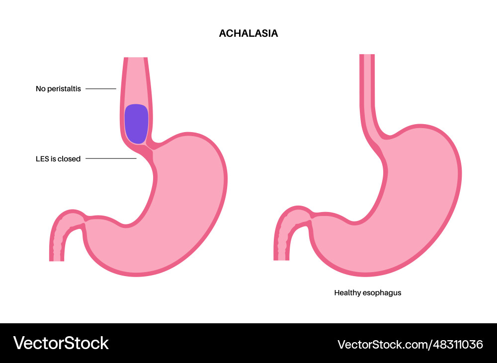 Esophageal achalasia disease Royalty Free Vector Image