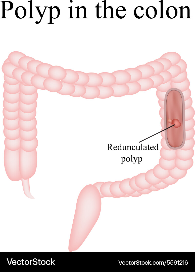 Polyp in the intestine in the colon Royalty Free Vector