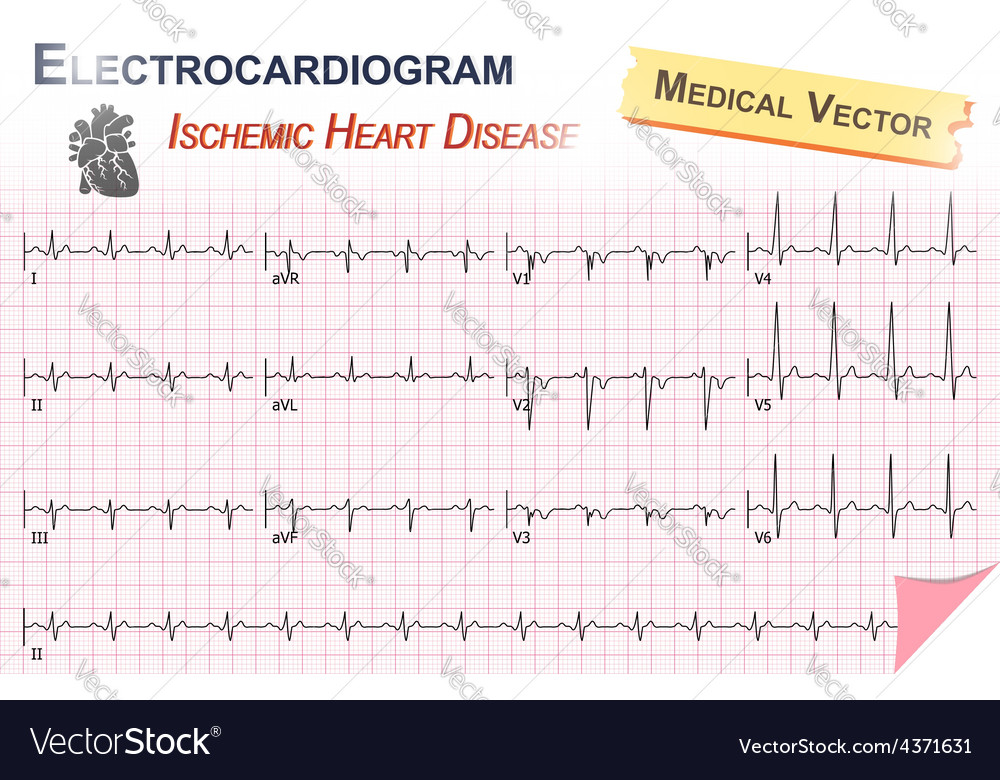 Electrocardiogram Royalty Free Vector Image - VectorStock