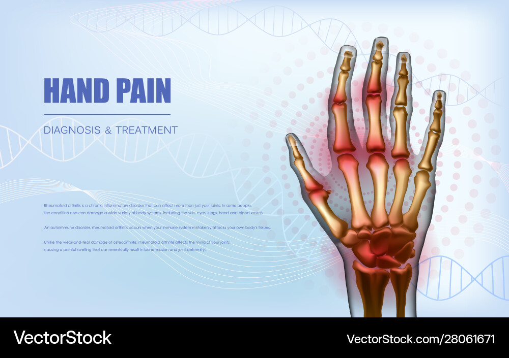 Osteoarthritis rheumatoid arthritis hand sore Vector Image