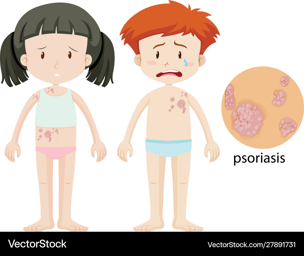 Boy and girl with psoriasis Royalty Free Vector Image