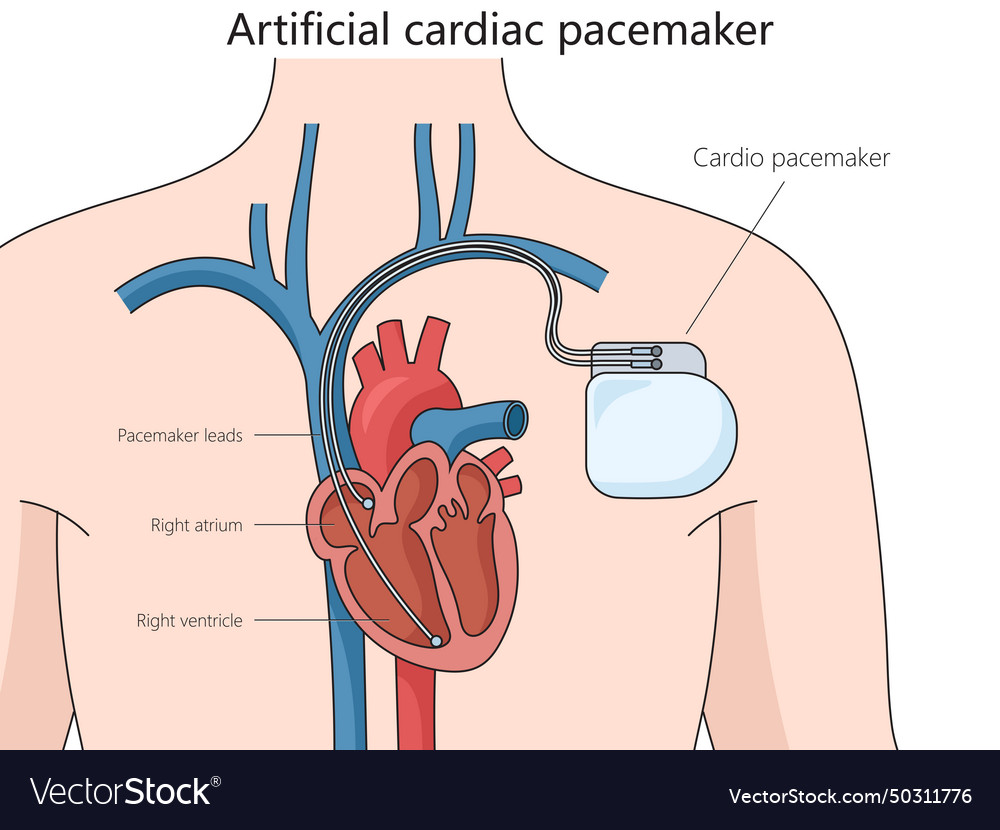 Artificial cardiac pacemaker medical device Vector Image