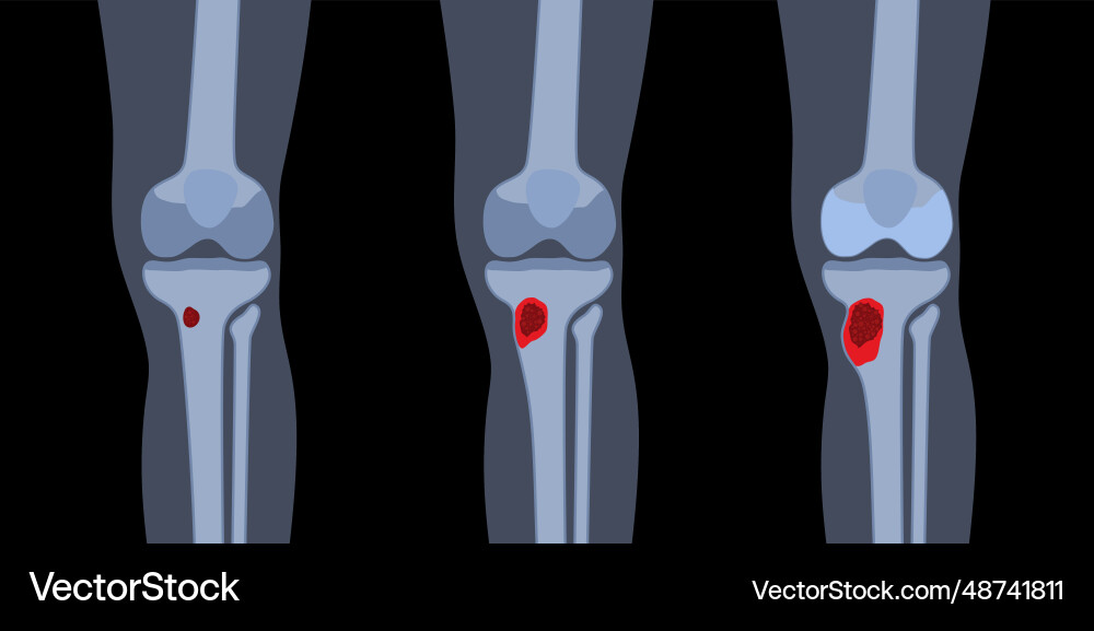 Tibia bone osteomyelitis Royalty Free Vector Image