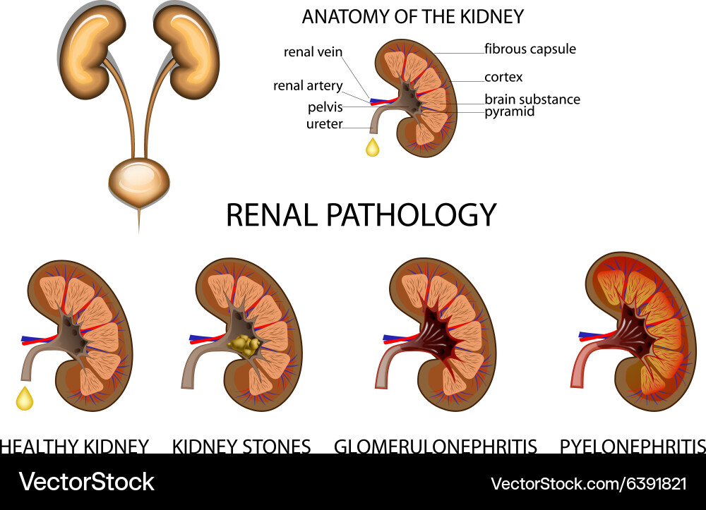 Pathology of the kidneys Royalty Free Vector Image