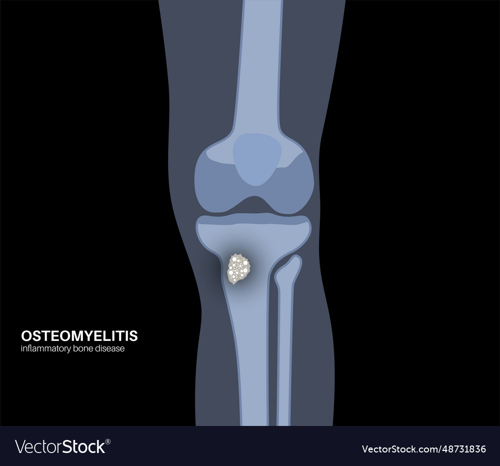 Tibia bone osteomyelitis Royalty Free Vector Image