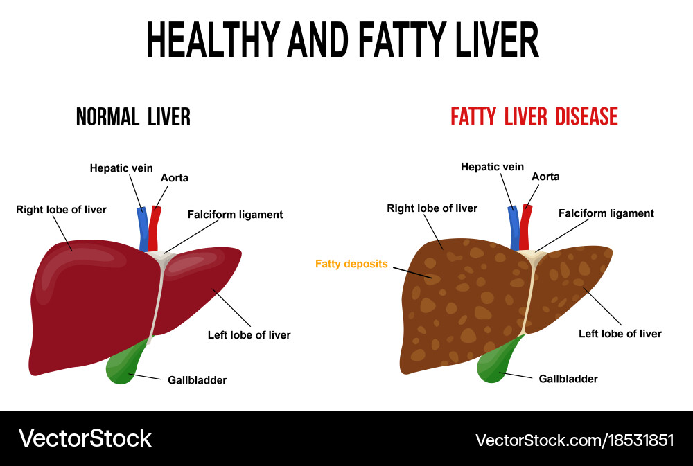 Healthy and fatty liver Royalty Free Vector Image