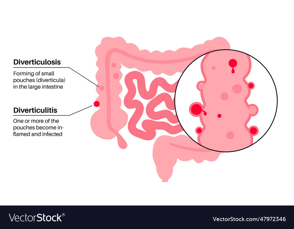 Diverticulitis And Diverticulosis Royalty Free Vector Image