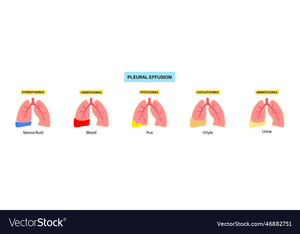 Pleural Effusion Poster Royalty Free Vector Image
