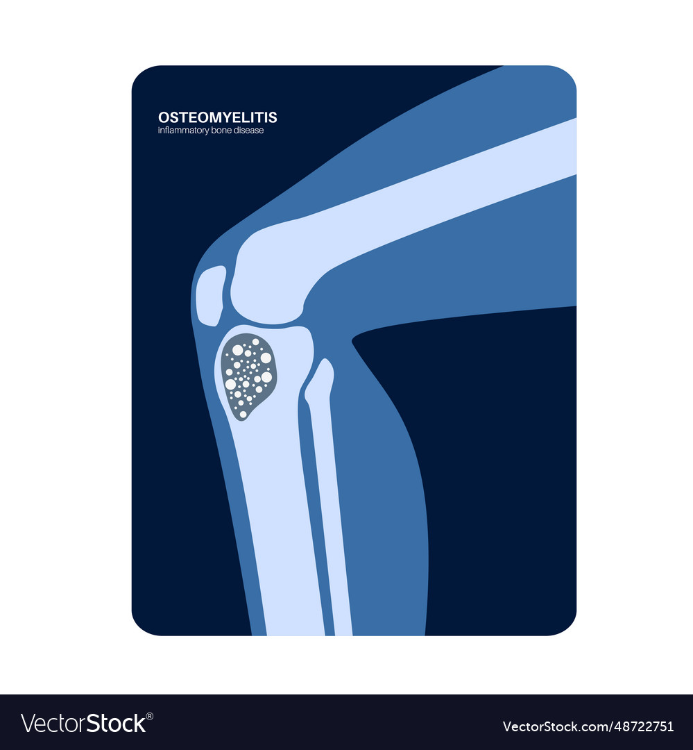 Tibia bone osteomyelitis Royalty Free Vector Image