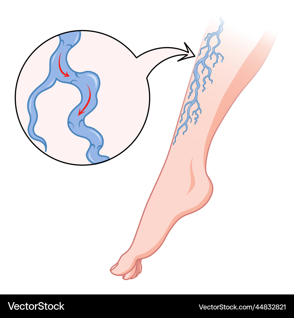 Varicose veins blue blood vessel visible through Vector Image