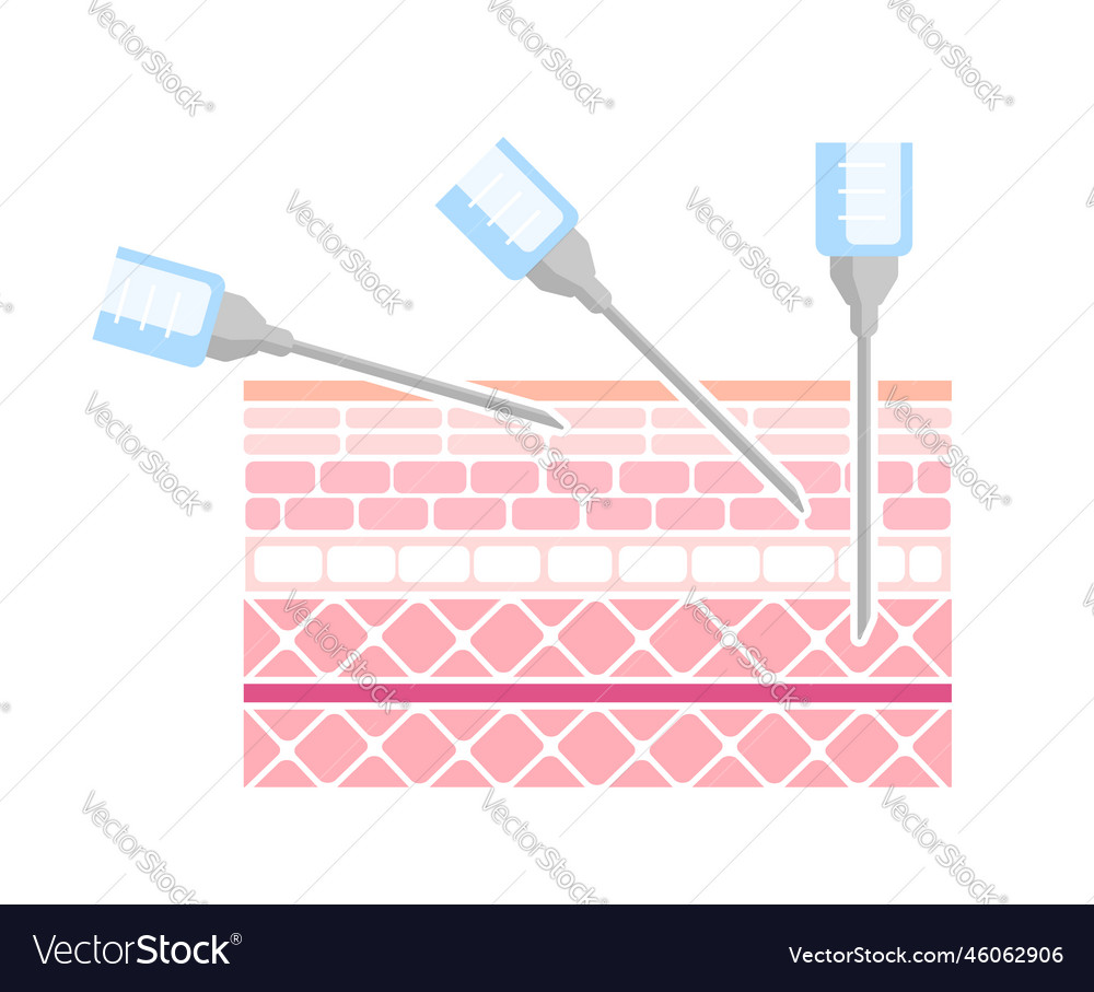 Angles For Inserting Injections Royalty Free Vector Image