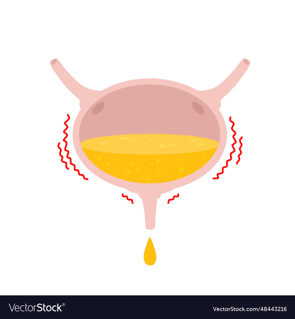 Overactive bladder urinal overflow Royalty Free Vector Image