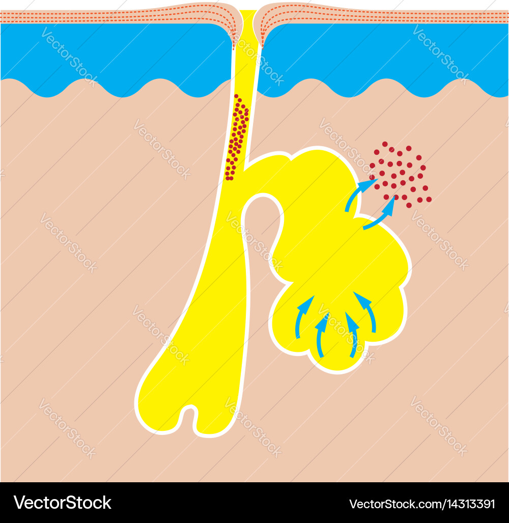 Acne vulgaris or pimple formation process Vector Image