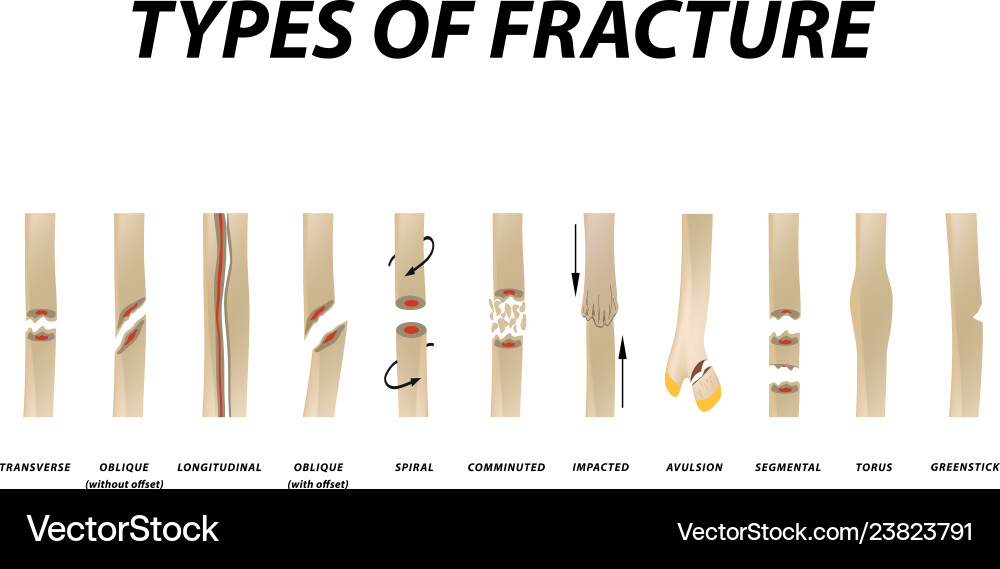 Types of fracture bone set infographics Royalty Free Vector