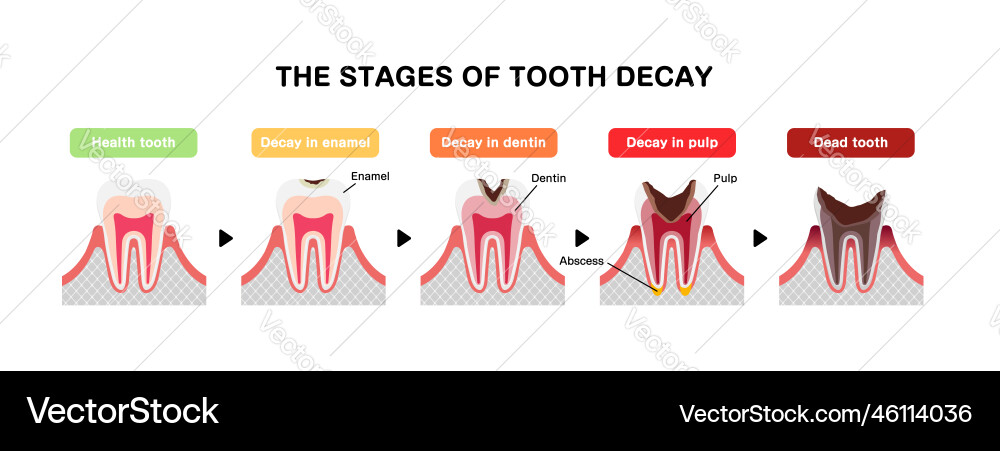 Stages of tooth decay flat Royalty Free Vector Image