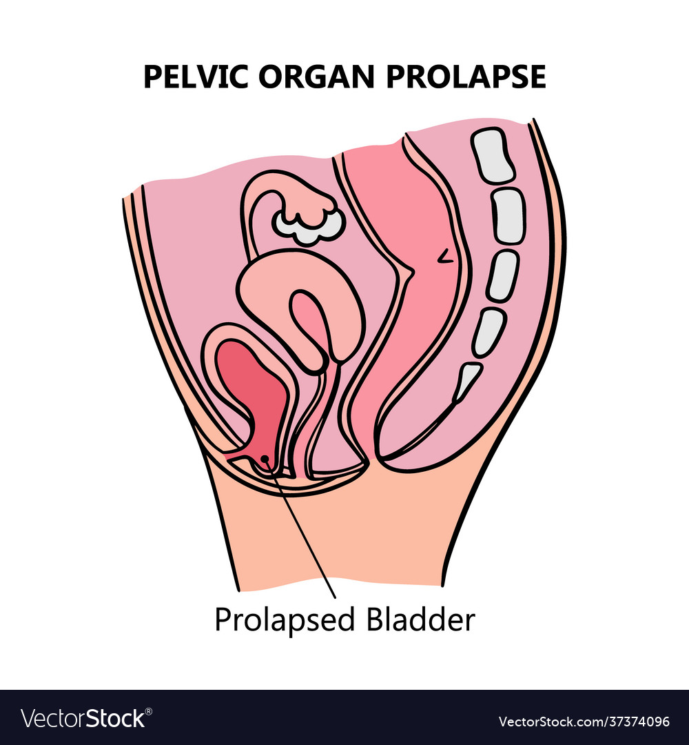 Prolapsed Bladder Women Medical Education Vector Image