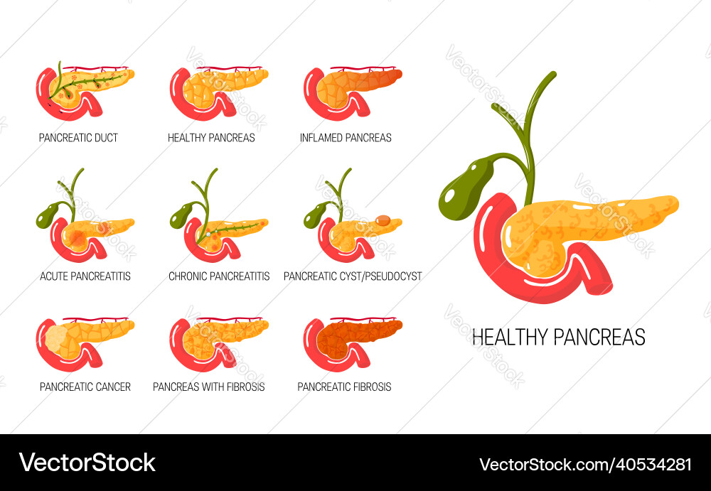 Pancreas diseases concept in flat style Royalty Free Vector