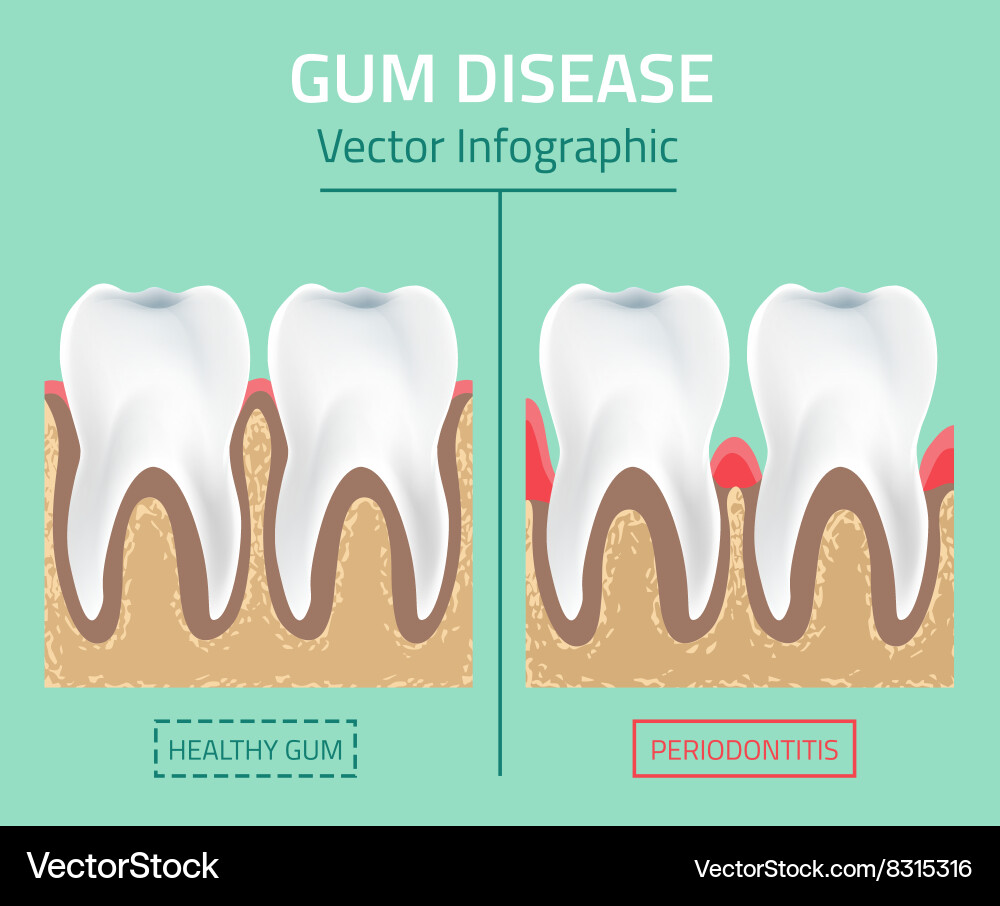 Teeth infographic Gum disease stages Royalty Free Vector