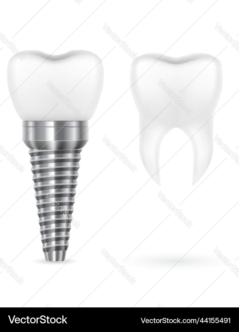 Metal human tooth implant Royalty Free Vector Image