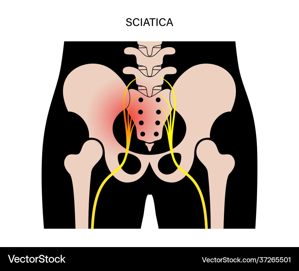 Sciatica Pain Anatomy Royalty Free Vector Image