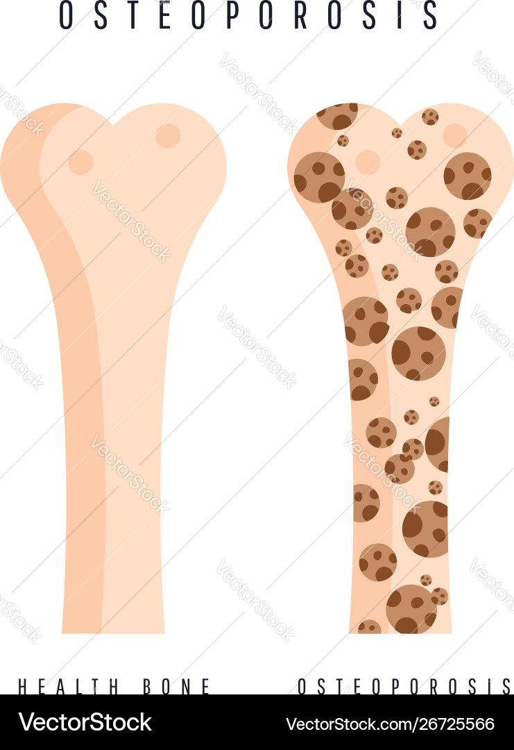 Osteoporosis Bone And Healthy Royalty Free Vector Image