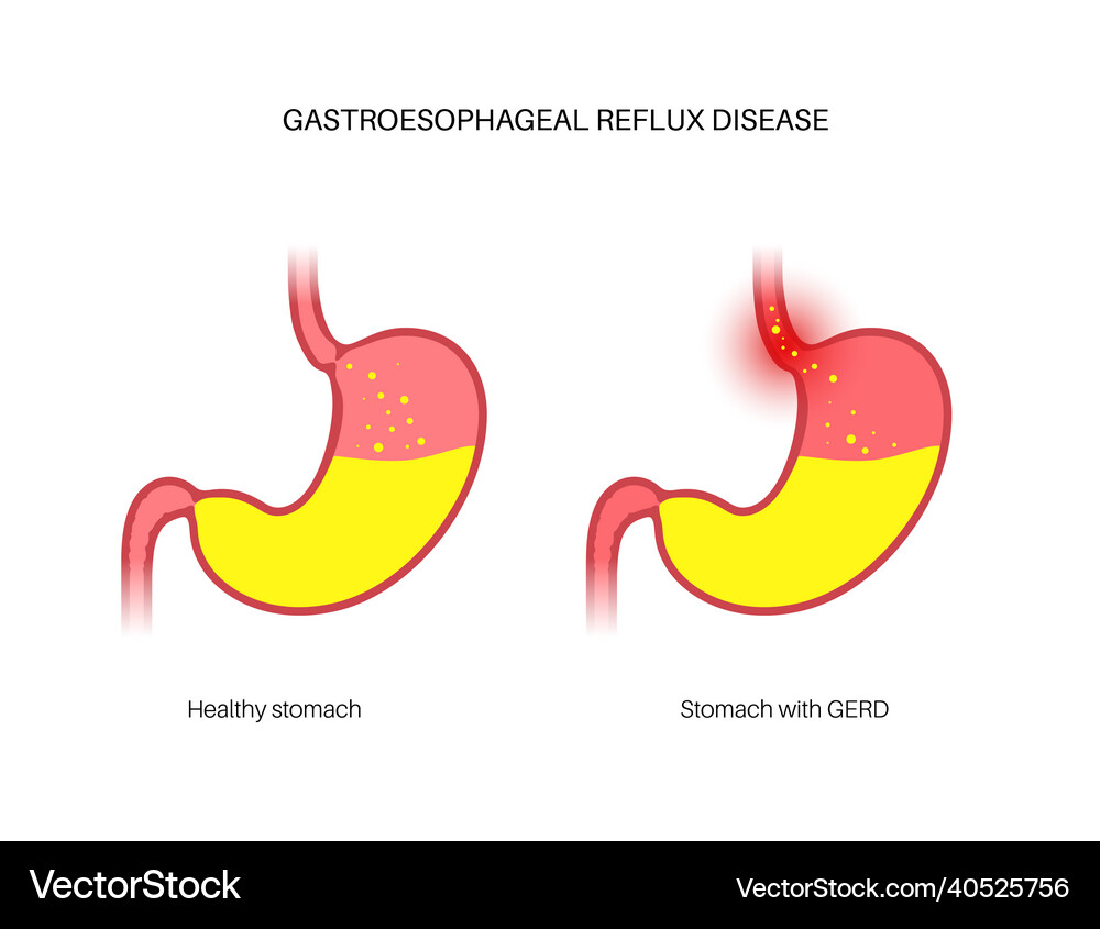 Gastroesophageal Reflux Disease (GERD) Royalty Free Vector