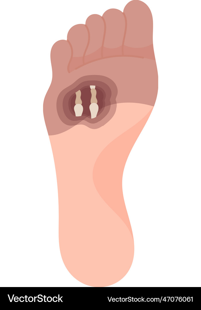 Gangrene forefoot disease Royalty Free Vector Image
