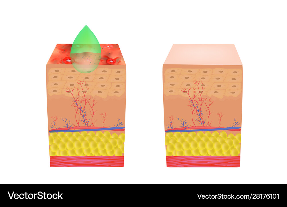 Peeling for acne inflamed skin Royalty Free Vector Image