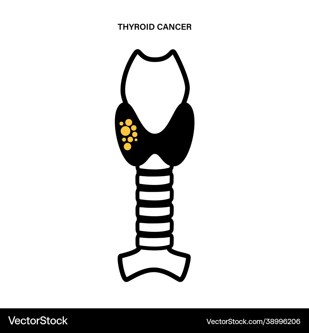 Thyroid cancer stages Royalty Free Vector Image