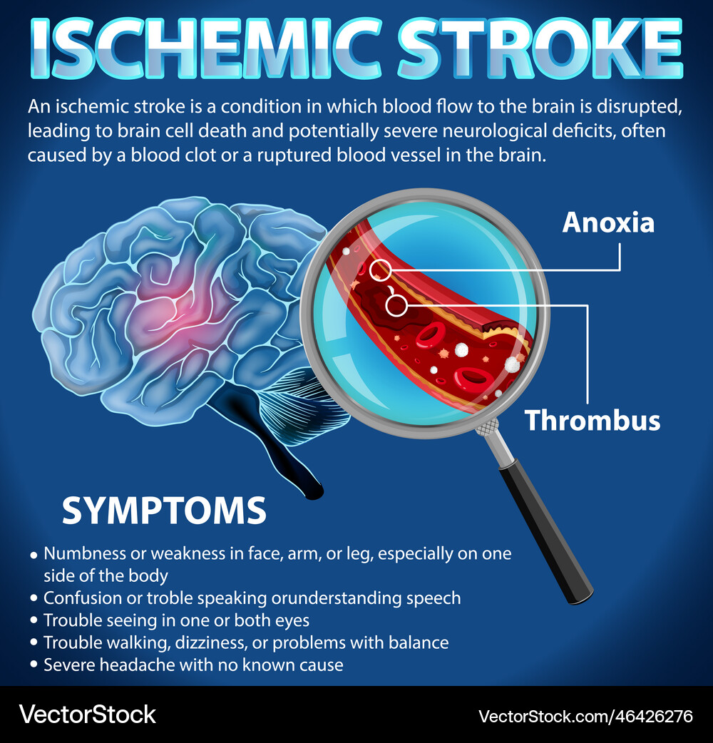 Informative poster of ischemic stroke Royalty Free Vector
