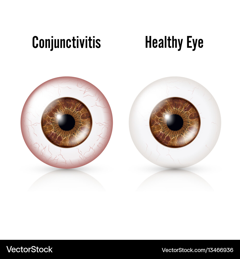 Conjunctivitis red eye healthy and eyeball Vector Image