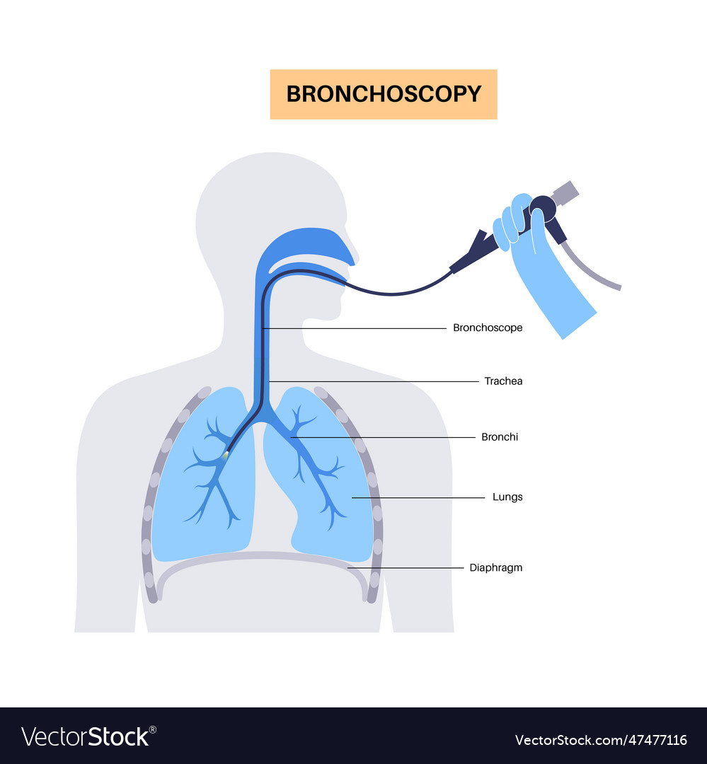 Bronchoscopy procedure concept Royalty Free Vector Image