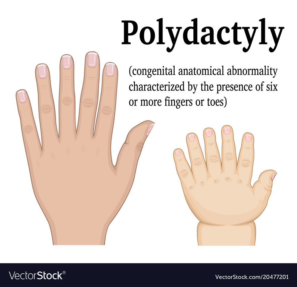 Polydactyly Royalty Free Vector Image - VectorStock