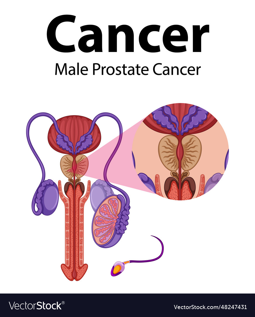 Comparing Normal And Cancer Prostate Royalty Free Vector