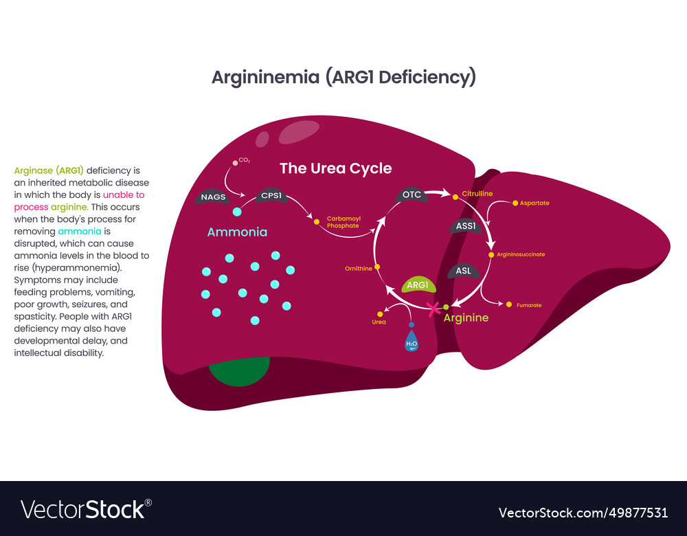 Argininemia arginase arg1 deficiency Royalty Free Vector Argininemia arginase arg1 deficiency Royalty Free Vector