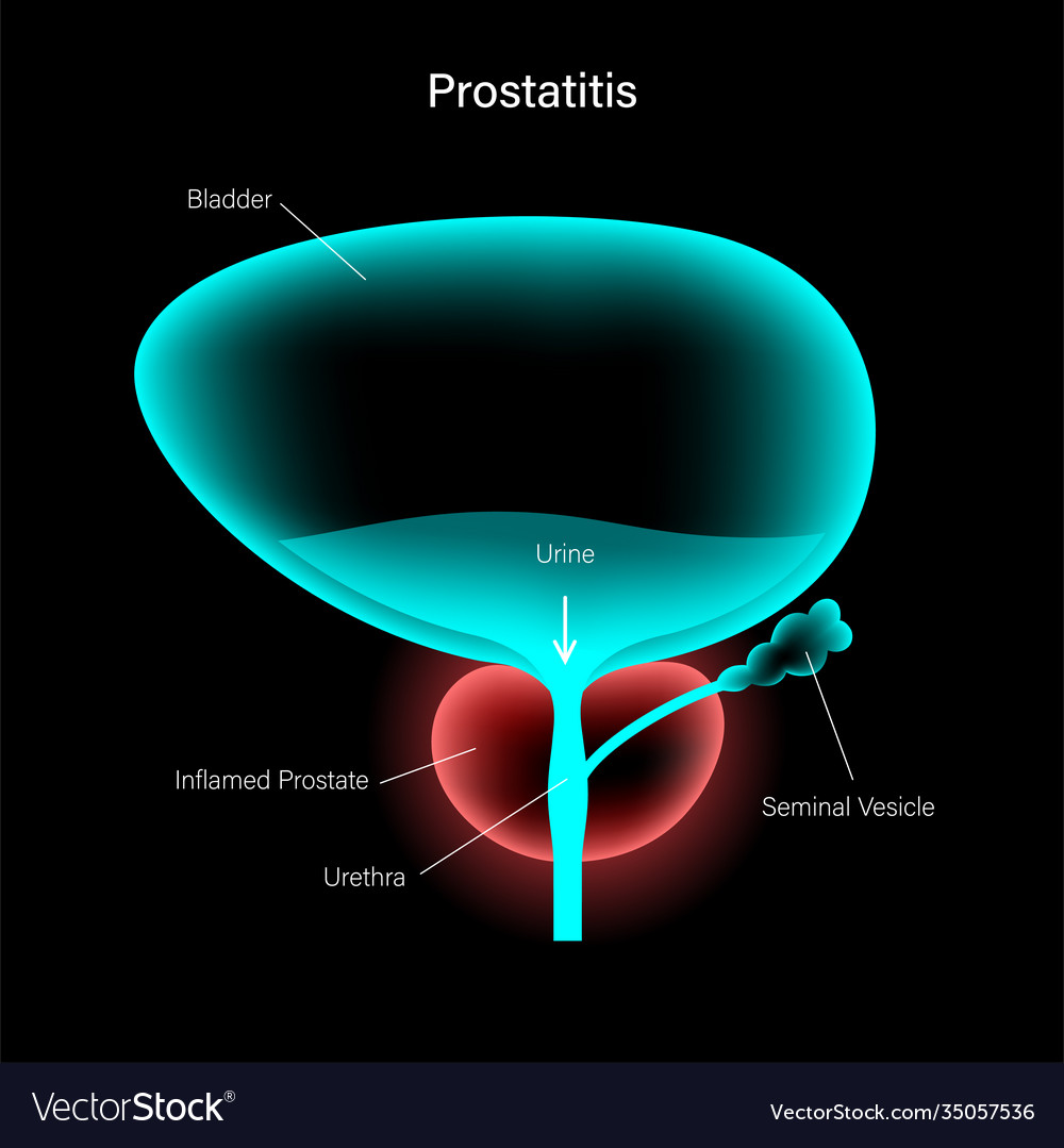 Prostatitis inflammation problem Royalty Free Vector Image