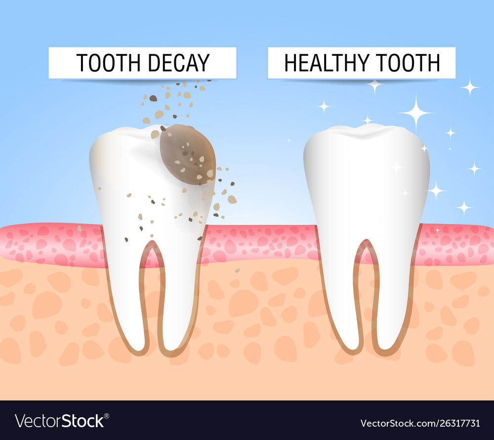 Dentistry teeth treatment whitening Royalty Free Vector