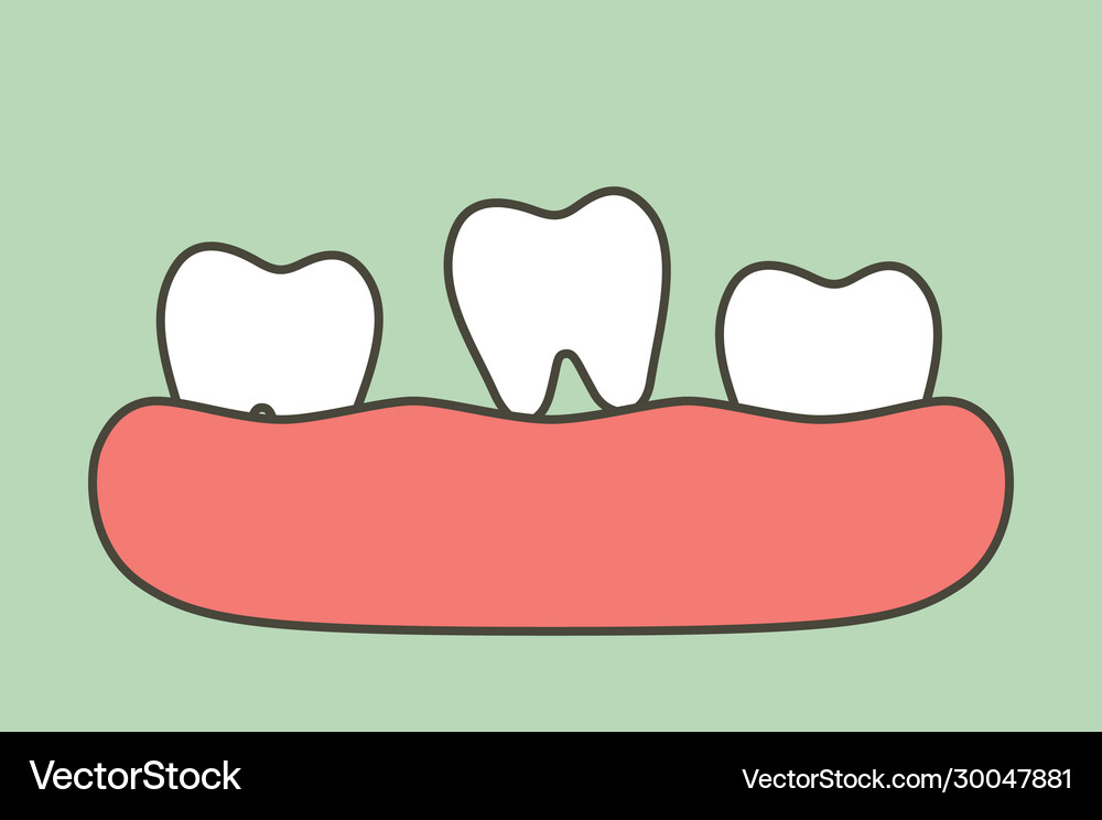 Loose tooth - tooth is fall out gum Royalty Free Vector