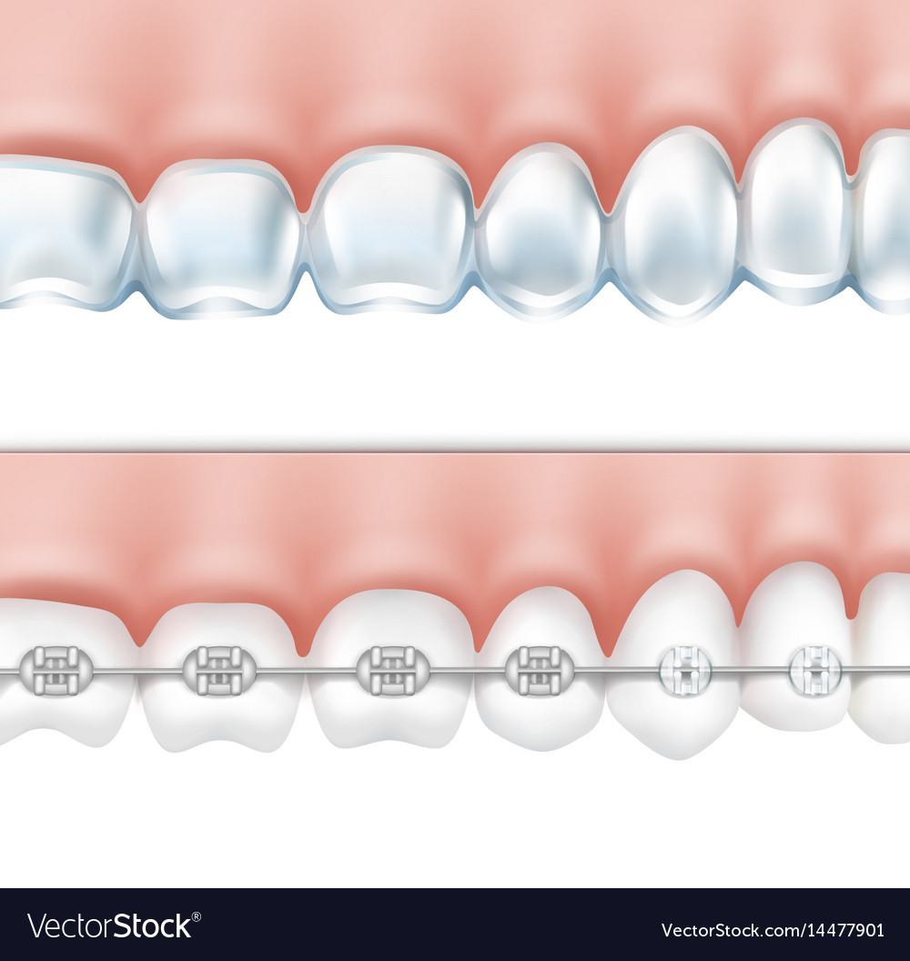 Human teeth with braces set Royalty Free Vector Image Human teeth with braces set Royalty Free Vector Image