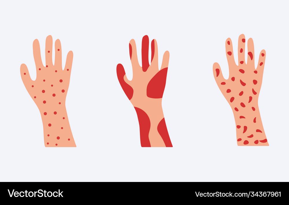 Skin allergy set hands covered red rash Royalty Free Vector