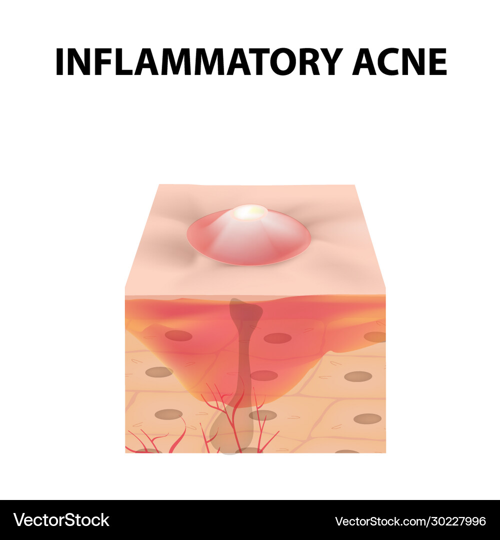 Cyst acne acne on skin a Royalty Free Vector Image