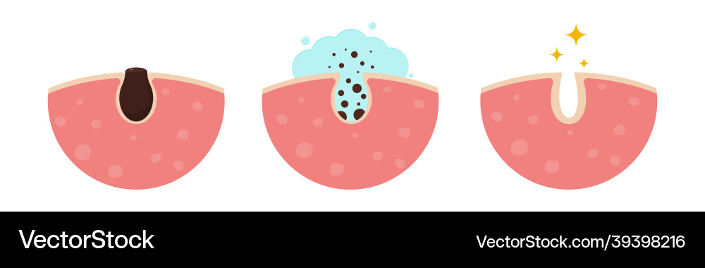 Cleaning clogged pores skin Royalty Free Vector Image