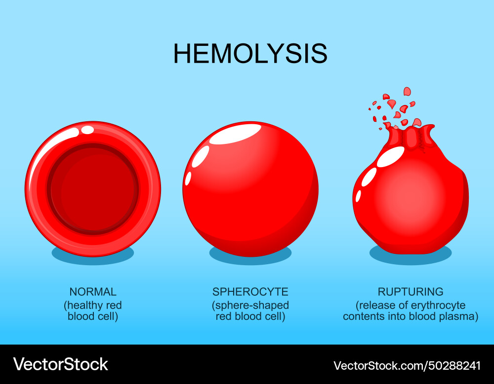 Hemolysis normal red blood cell spherocyte Vector Image